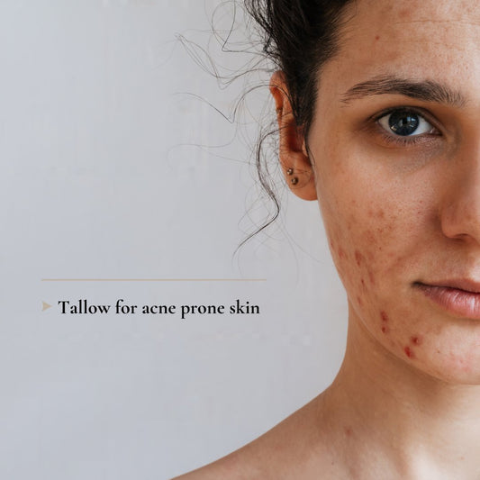Tallow for Acne: The Natural Skincare Solution | Nana Latta Skincare